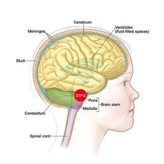 DIPG Facts | 4AydenStrong